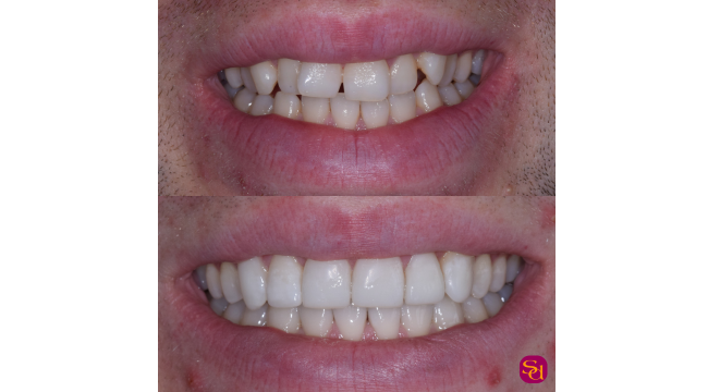 Invisalign vs Smile White: Which Clear Aligner System is Right for You ...